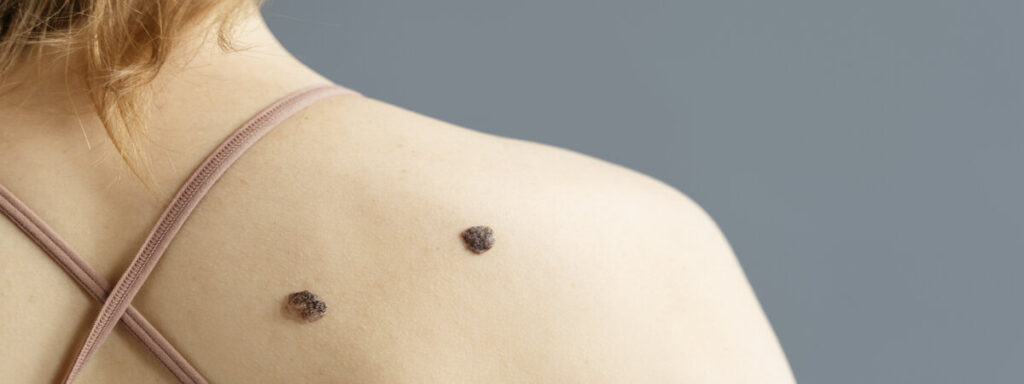 Dealing with a Scratched Mole: Risks and Solutions