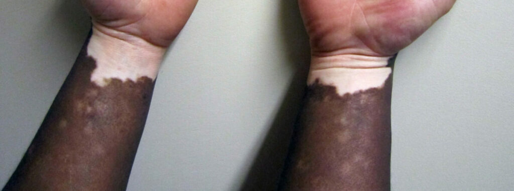 Understanding and Treating Vitiligo
