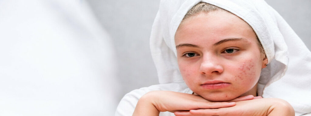 Understanding Teenage and Adult Acne