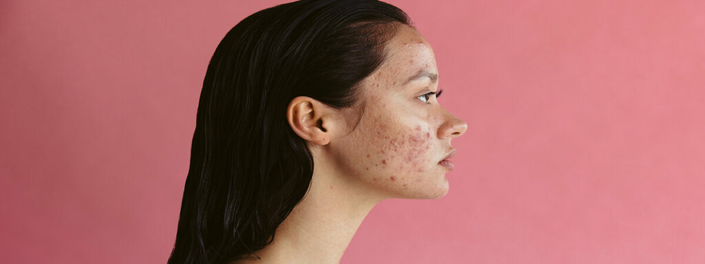 Diet and Acne: Unraveling Connections for Clearer Skin