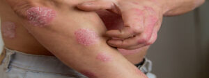 Managing Scarring from Psoriasis: Expert Solutions