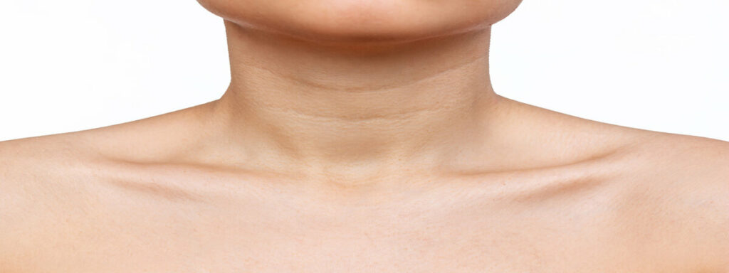Prevent & Treat Neck Lines: Dermatology Tips